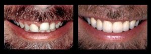 Gum Contouring | Vero Beach Art of Dentistry